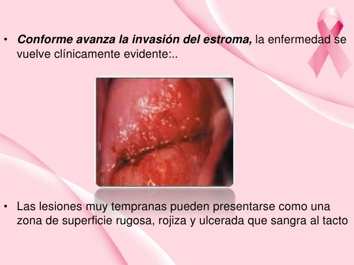 Cáncer Invasor De Cérvix 24 Febrero 2012