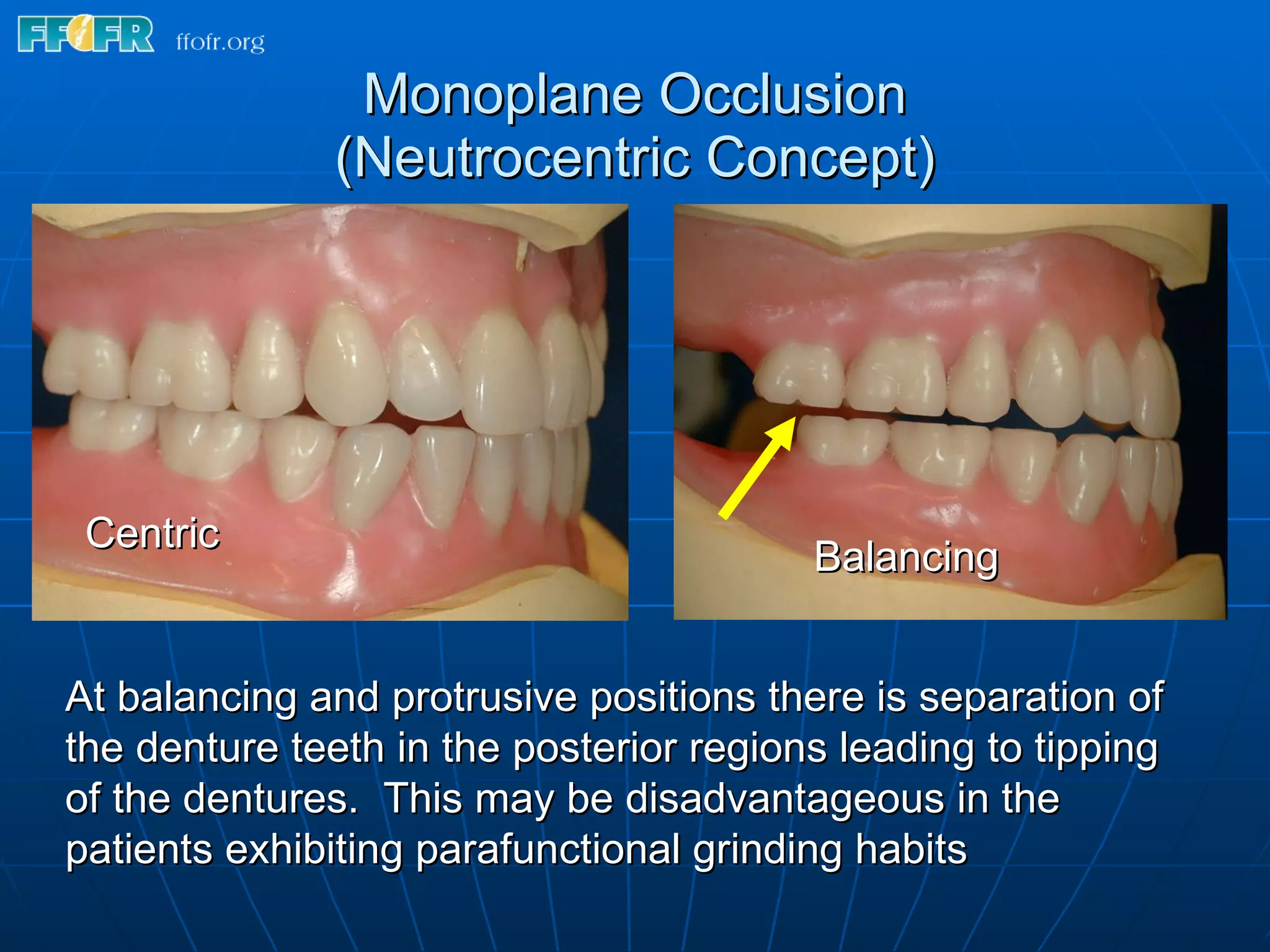 15.concepts of complete denture occlusion | PPT