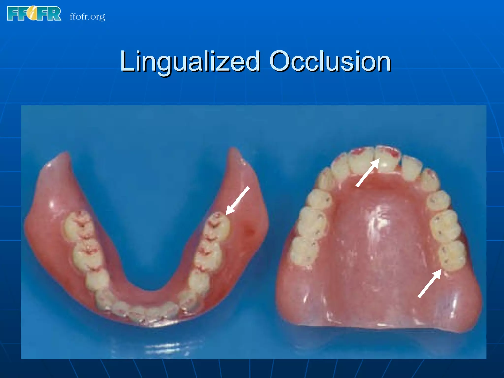 15.concepts of complete denture occlusion | PPT