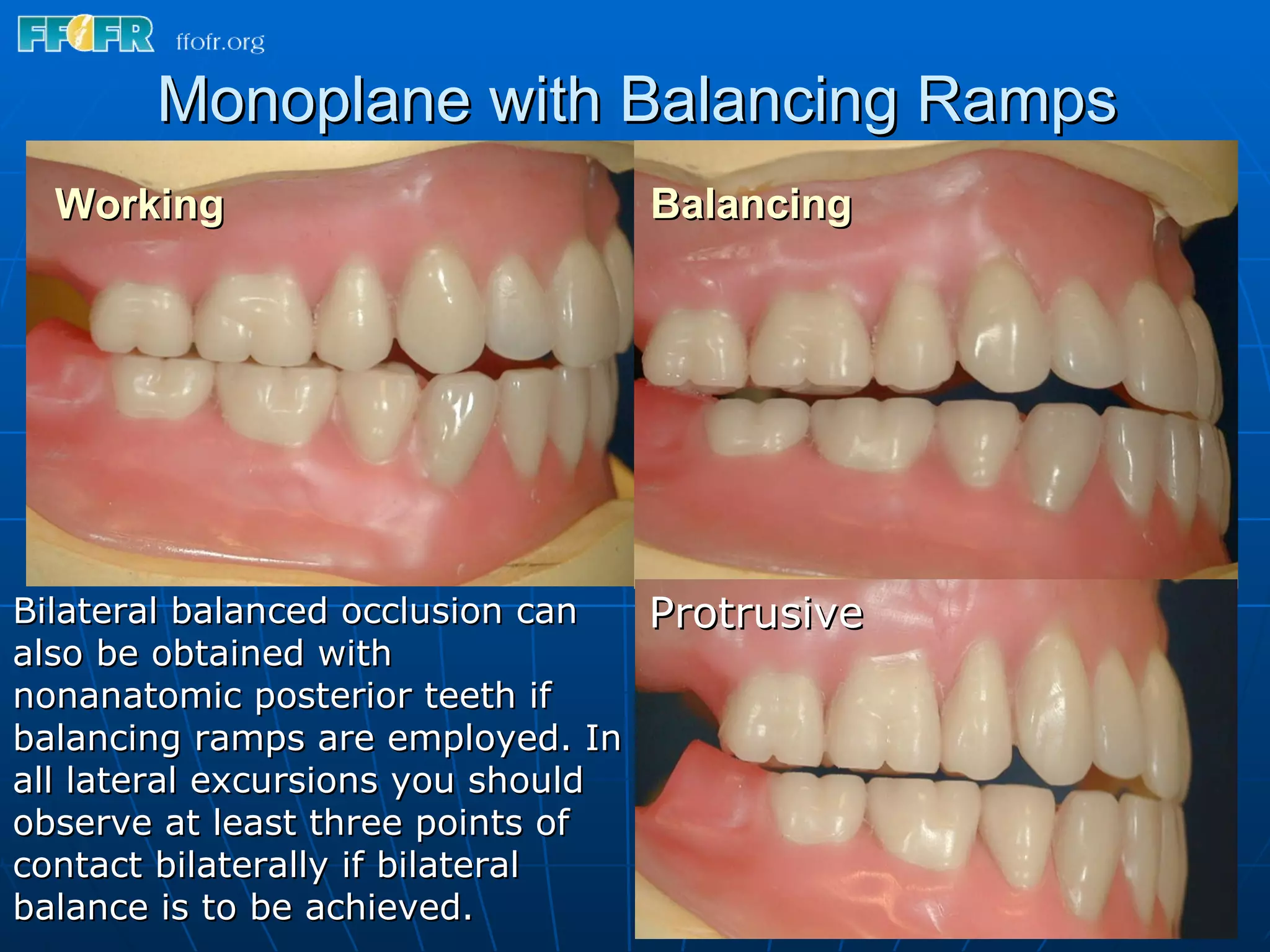 15.concepts of complete denture occlusion | PPT