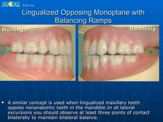 15.concepts of complete denture occlusion | PPT