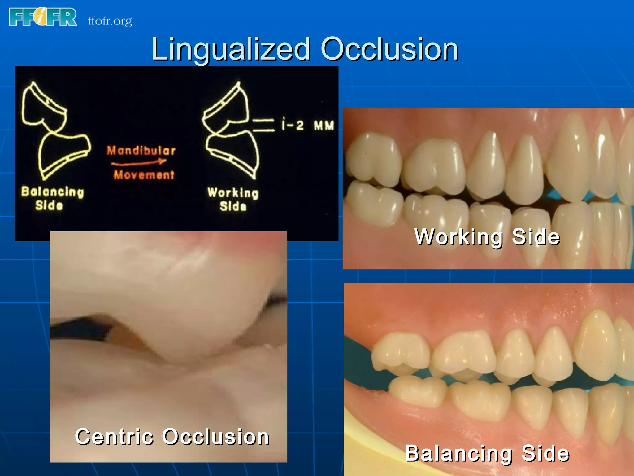 15.concepts of complete denture occlusion | PPT