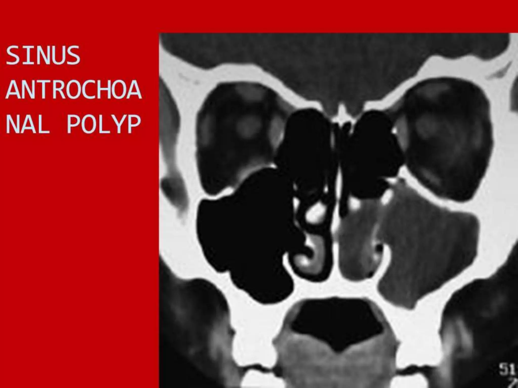 15-Dr Ahmed Esawy imaging oral board of sinus ,ear,fascial nerve ...