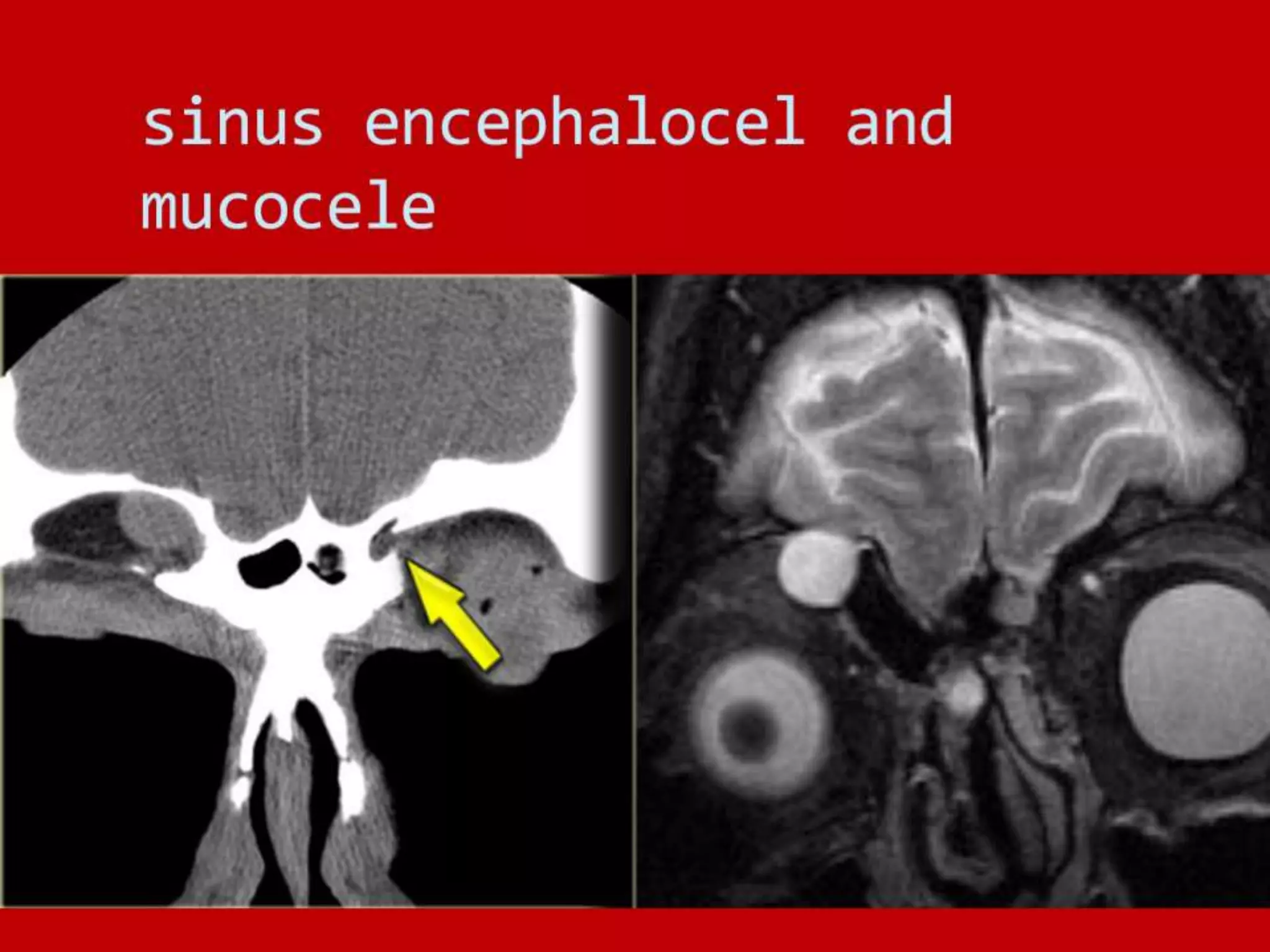 15-Dr Ahmed Esawy imaging oral board of sinus ,ear,fascial nerve ...