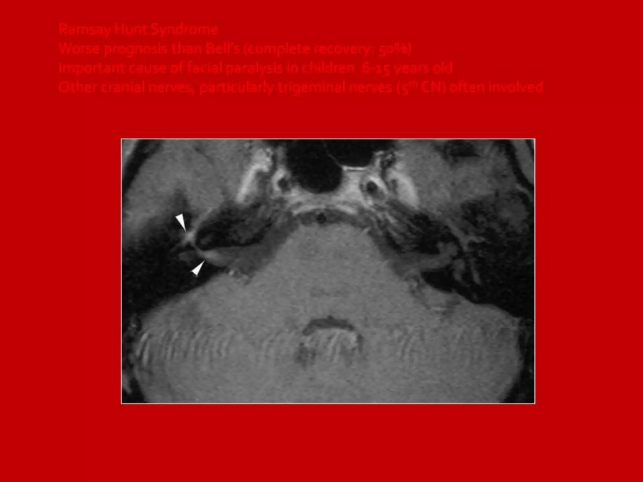 15-Dr Ahmed Esawy imaging oral board of sinus ,ear,fascial nerve ...