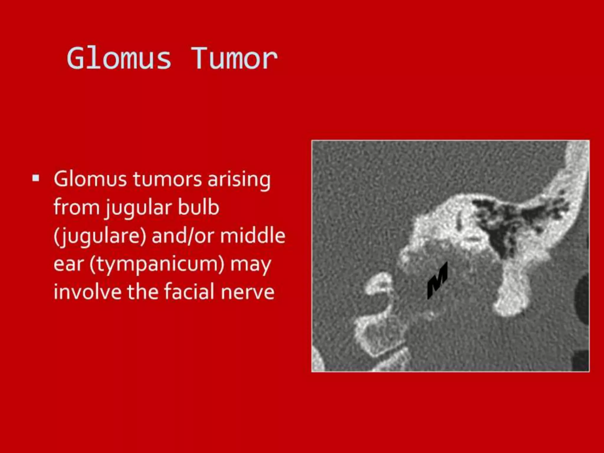 15-Dr Ahmed Esawy imaging oral board of sinus ,ear,fascial nerve ...