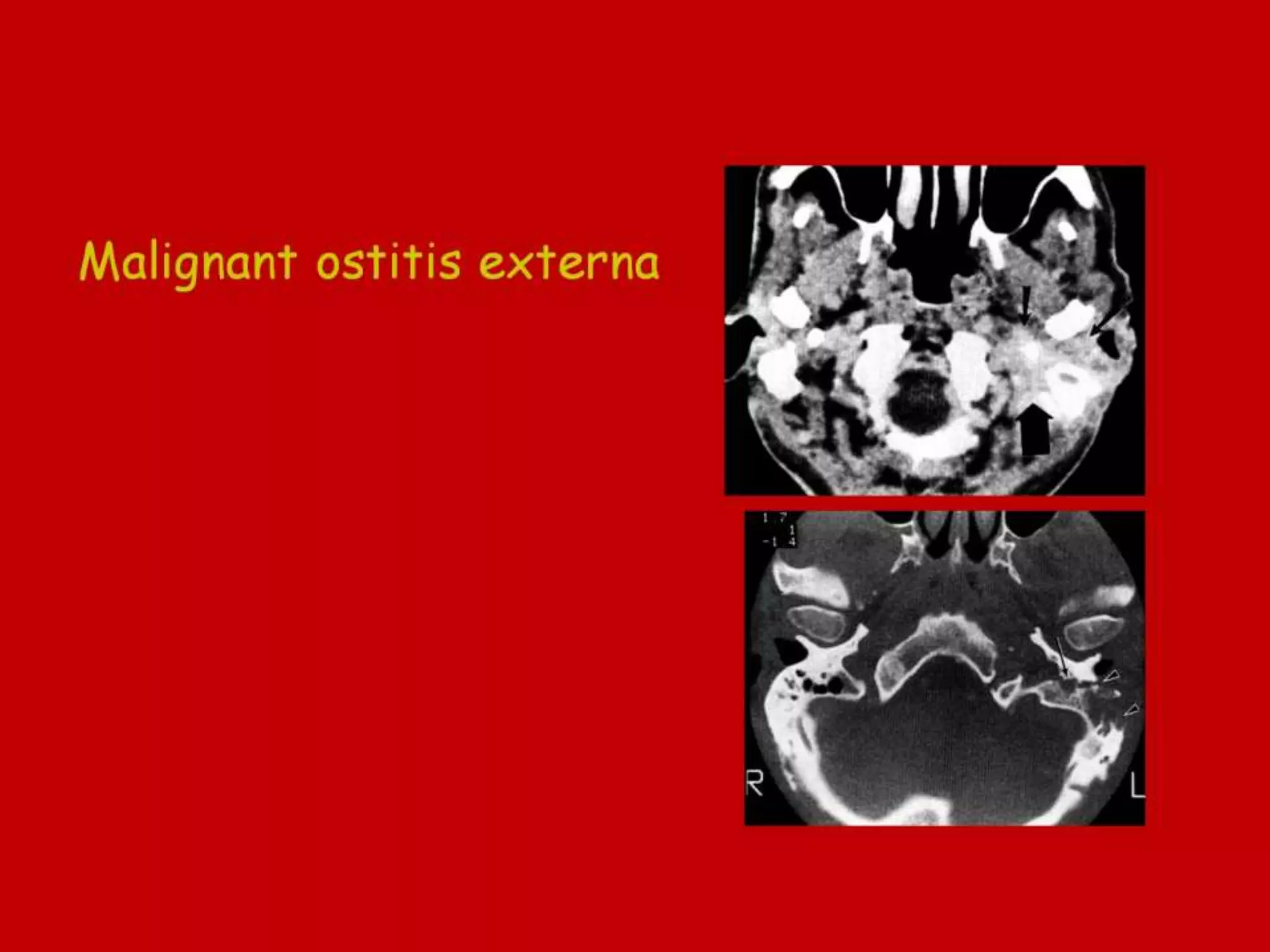 15-Dr Ahmed Esawy imaging oral board of sinus ,ear,fascial nerve ...