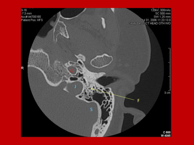 15-Dr Ahmed Esawy imaging oral board of sinus ,ear,fascial nerve ...