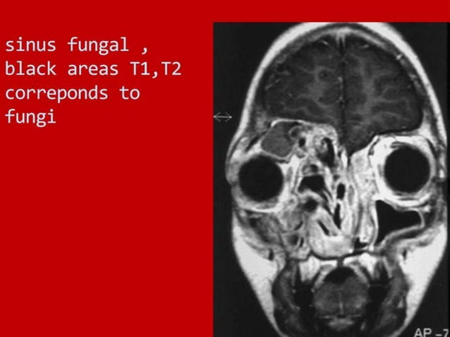 15-Dr Ahmed Esawy imaging oral board of sinus ,ear,fascial nerve ...
