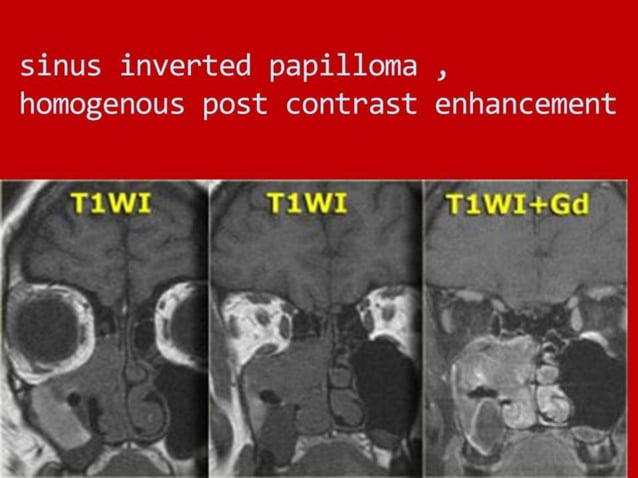 15-Dr Ahmed Esawy imaging oral board of sinus ,ear,fascial nerve ...