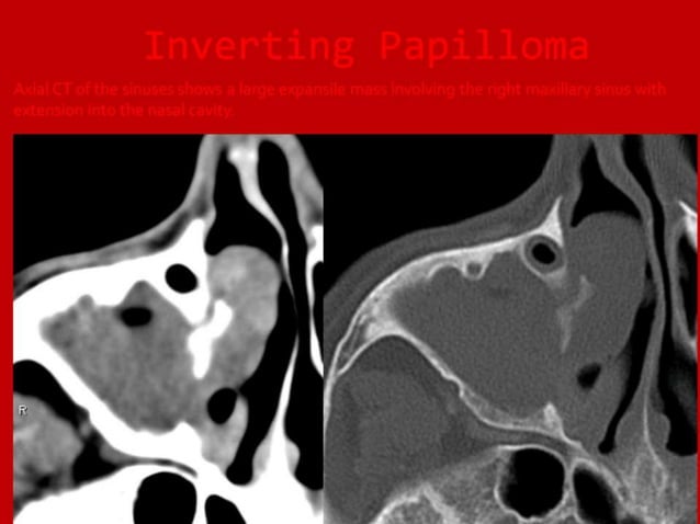 15-Dr Ahmed Esawy imaging oral board of sinus ,ear,fascial nerve ...