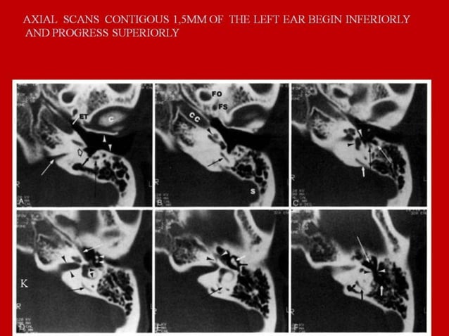 15-Dr Ahmed Esawy imaging oral board of sinus ,ear,fascial nerve ...