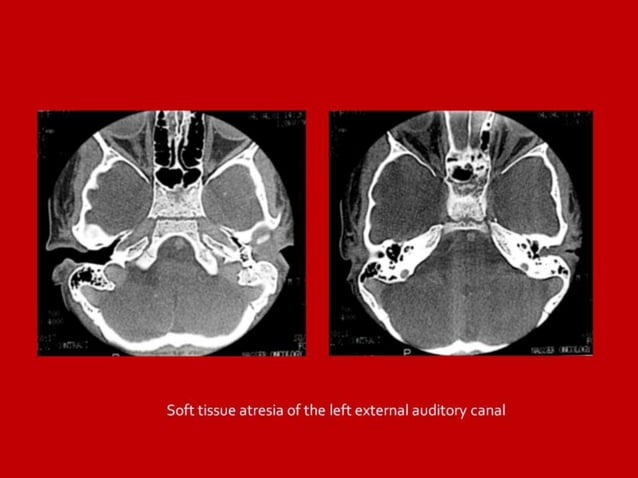15-Dr Ahmed Esawy imaging oral board of sinus ,ear,fascial nerve ...