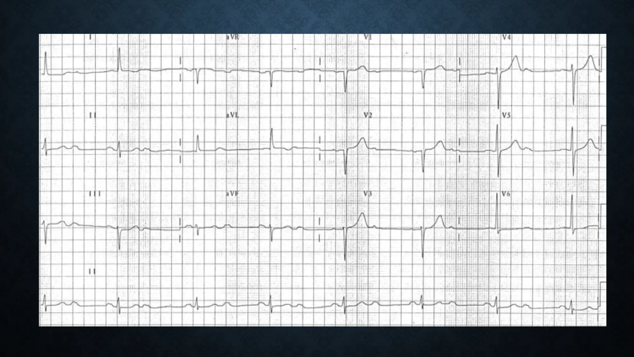 ECG Made Easy - Refresh your ECG Interpretation Skills | PPTX