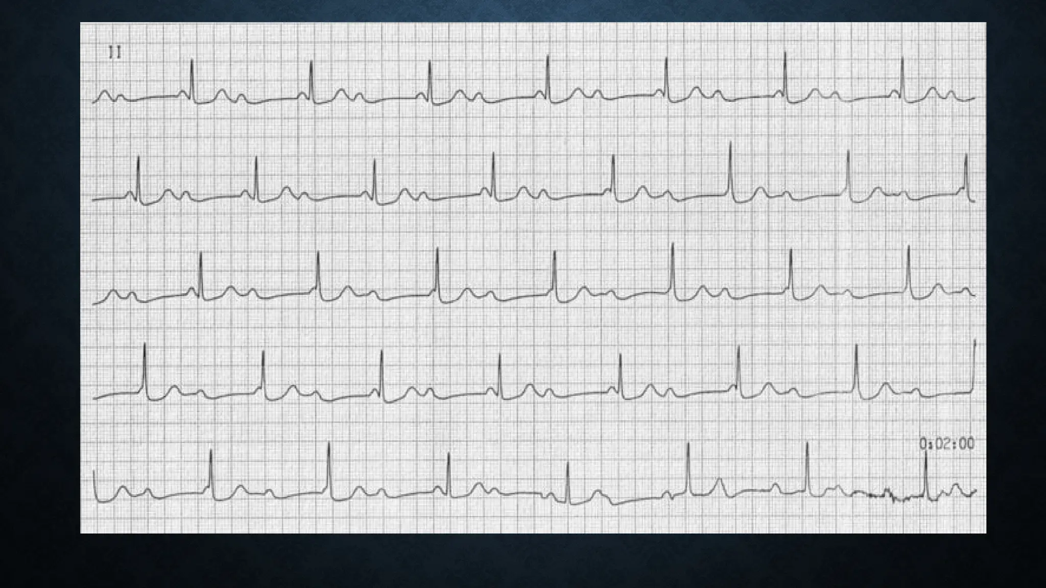 ECG Made Easy - Refresh your ECG Interpretation Skills | PPTX