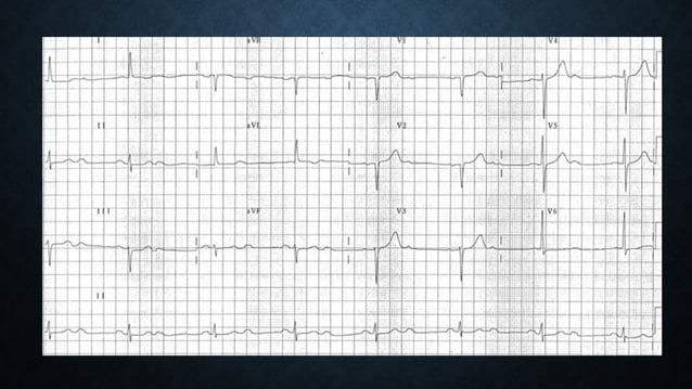 ECG Made Easy - Refresh your ECG Interpretation Skills | PPTX