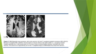 15-Imaging CNS tumors.pptx;:"#$#$#$#5==÷5=// | PPTX