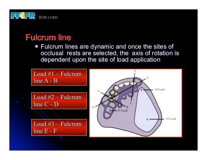 15. (new)definitive obturators partially edent patients