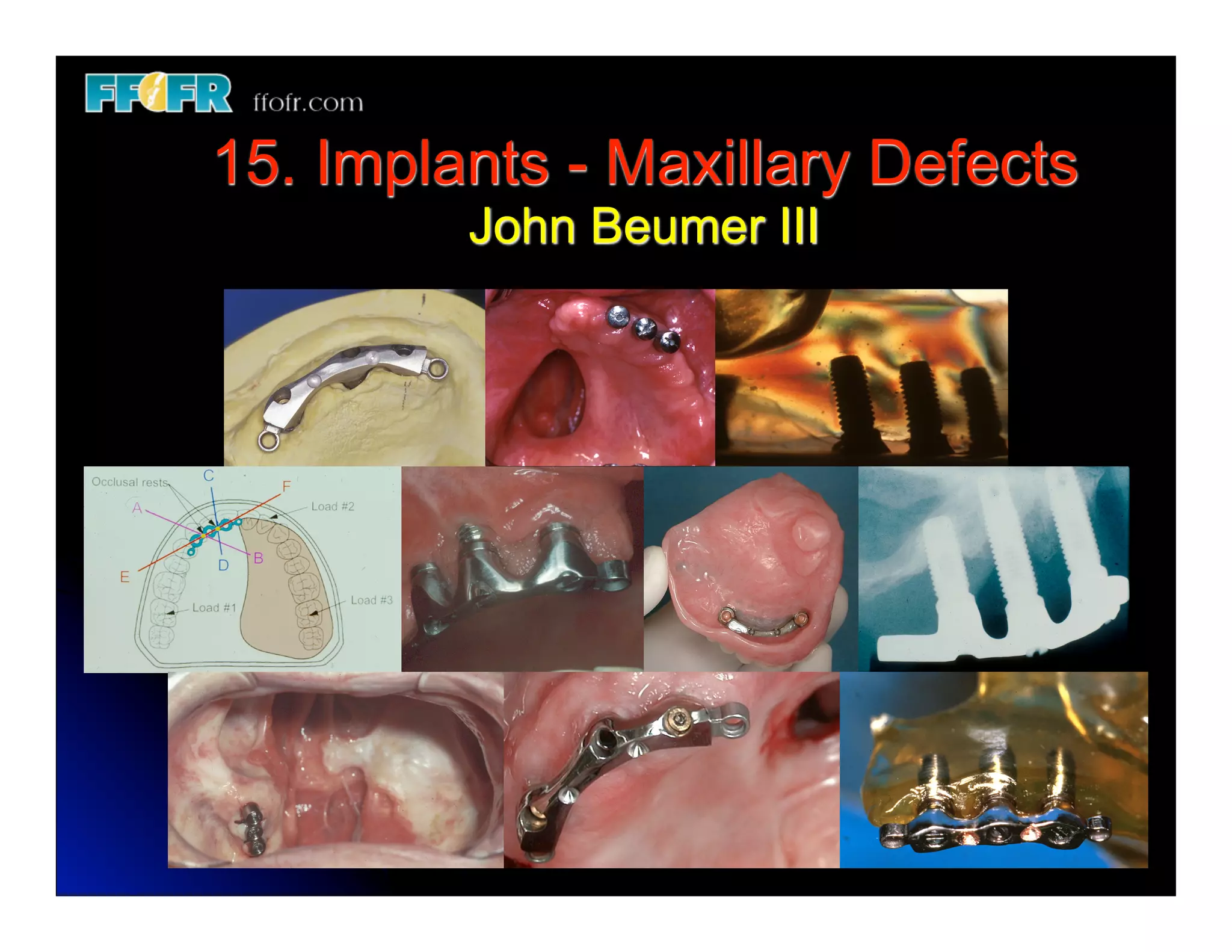 15. (new)implants maxillary defects | PDF