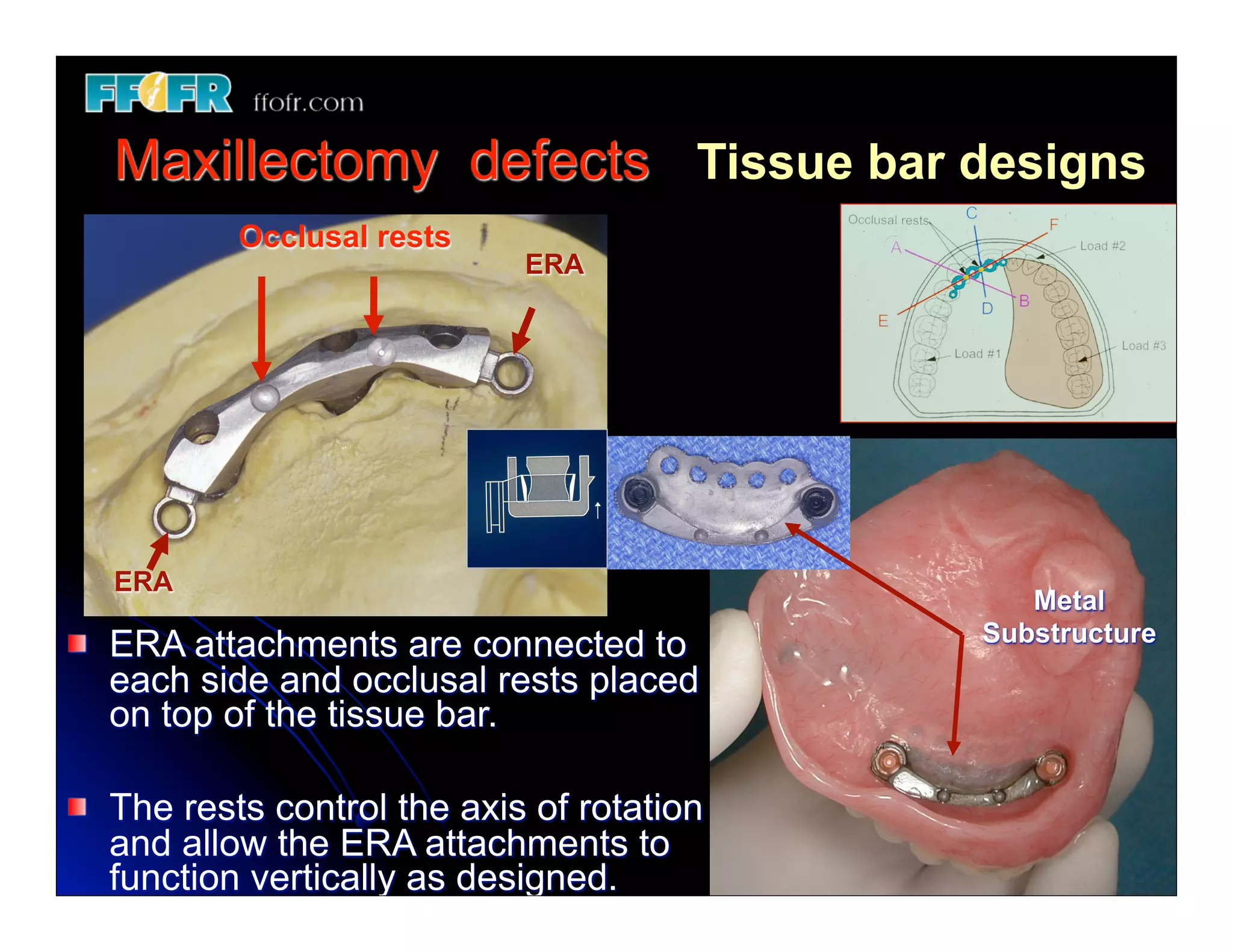15. (new)implants maxillary defects | PDF