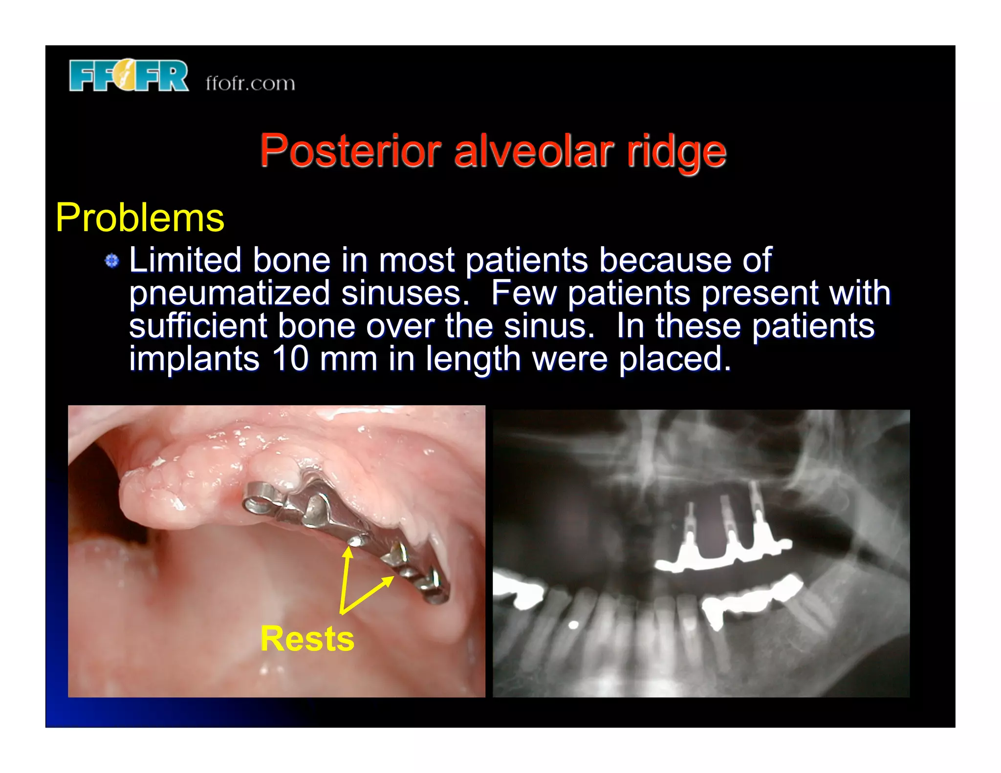 15. (new)implants maxillary defects | PDF