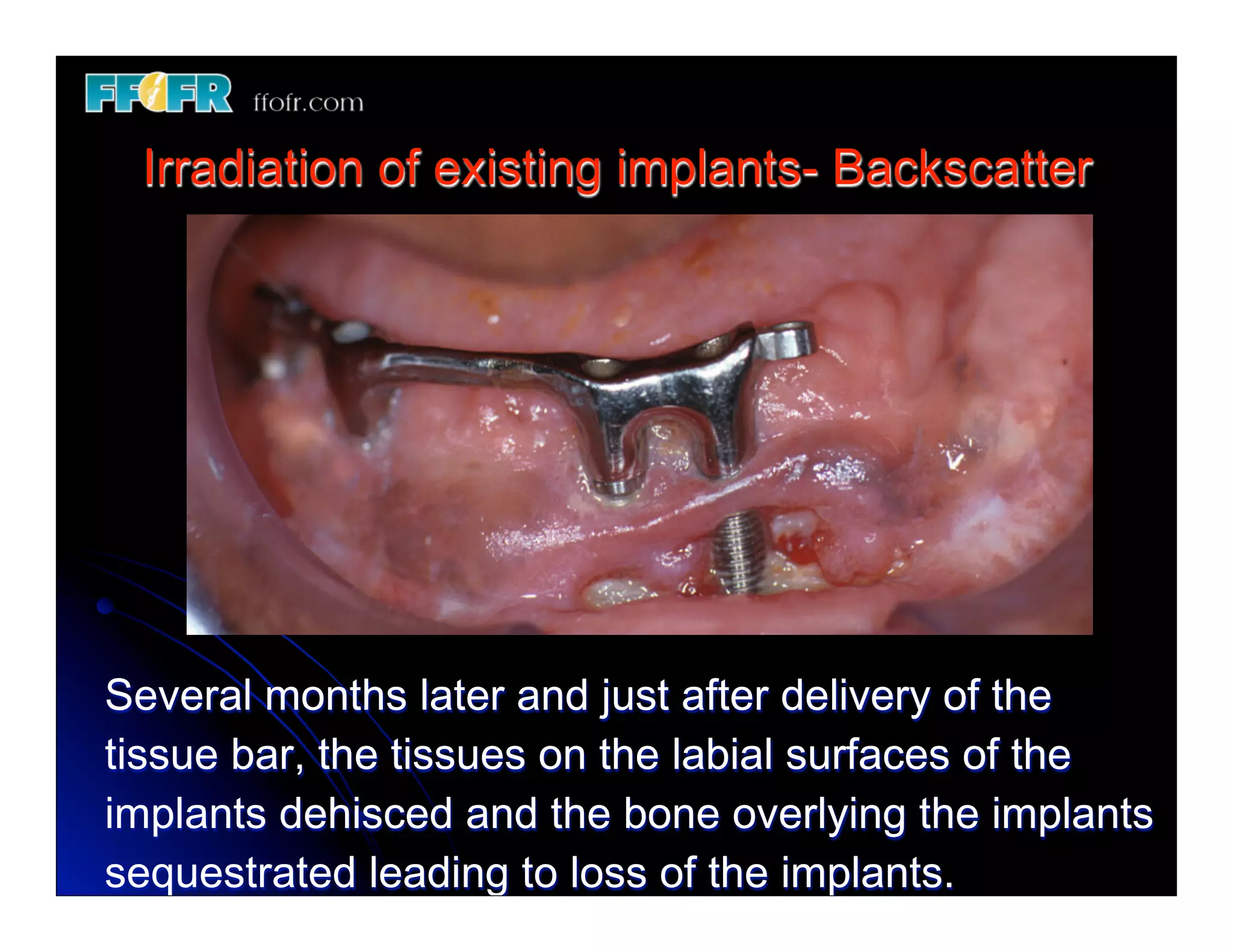 15. (new)implants maxillary defects | PDF
