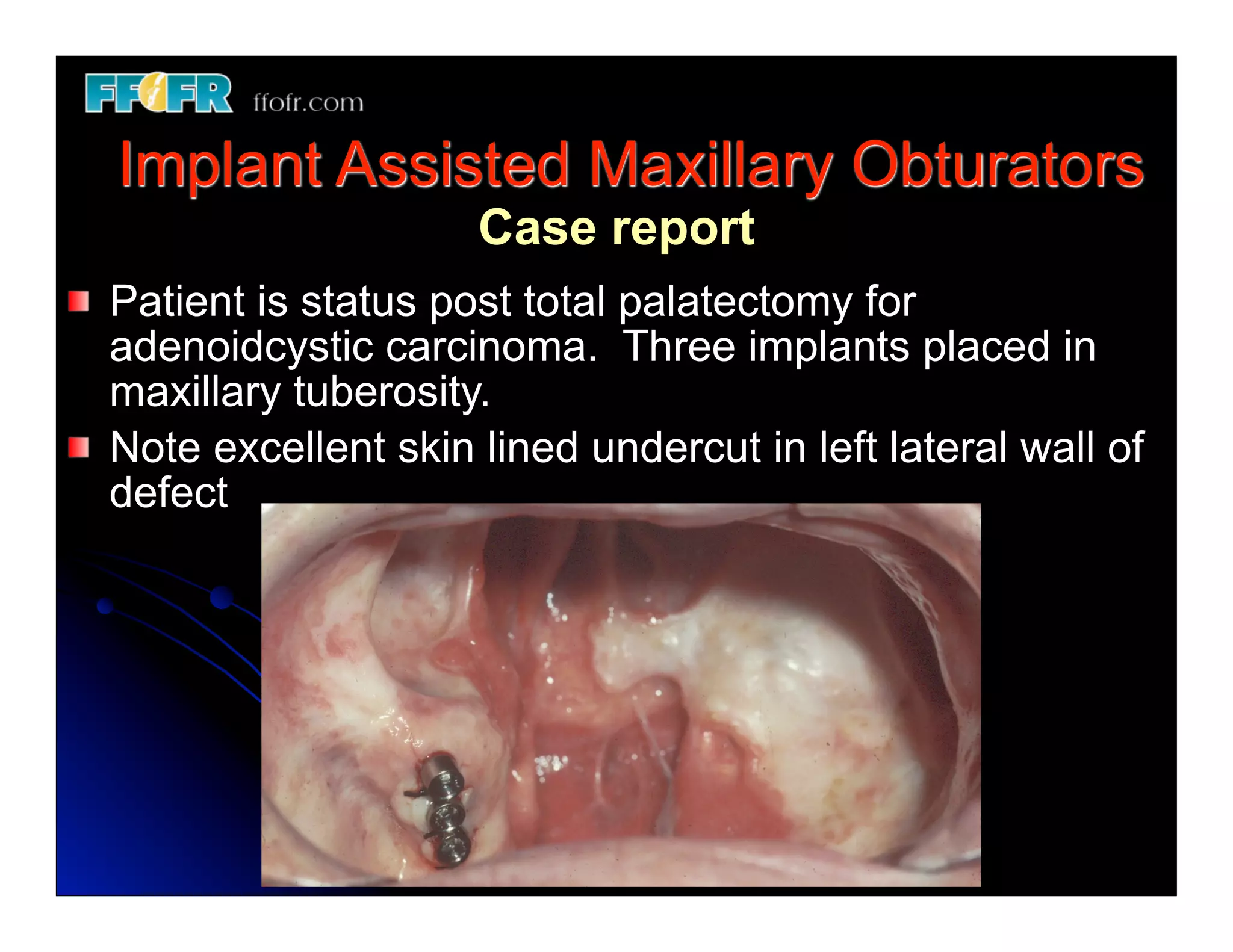 15. (new)implants maxillary defects | PDF
