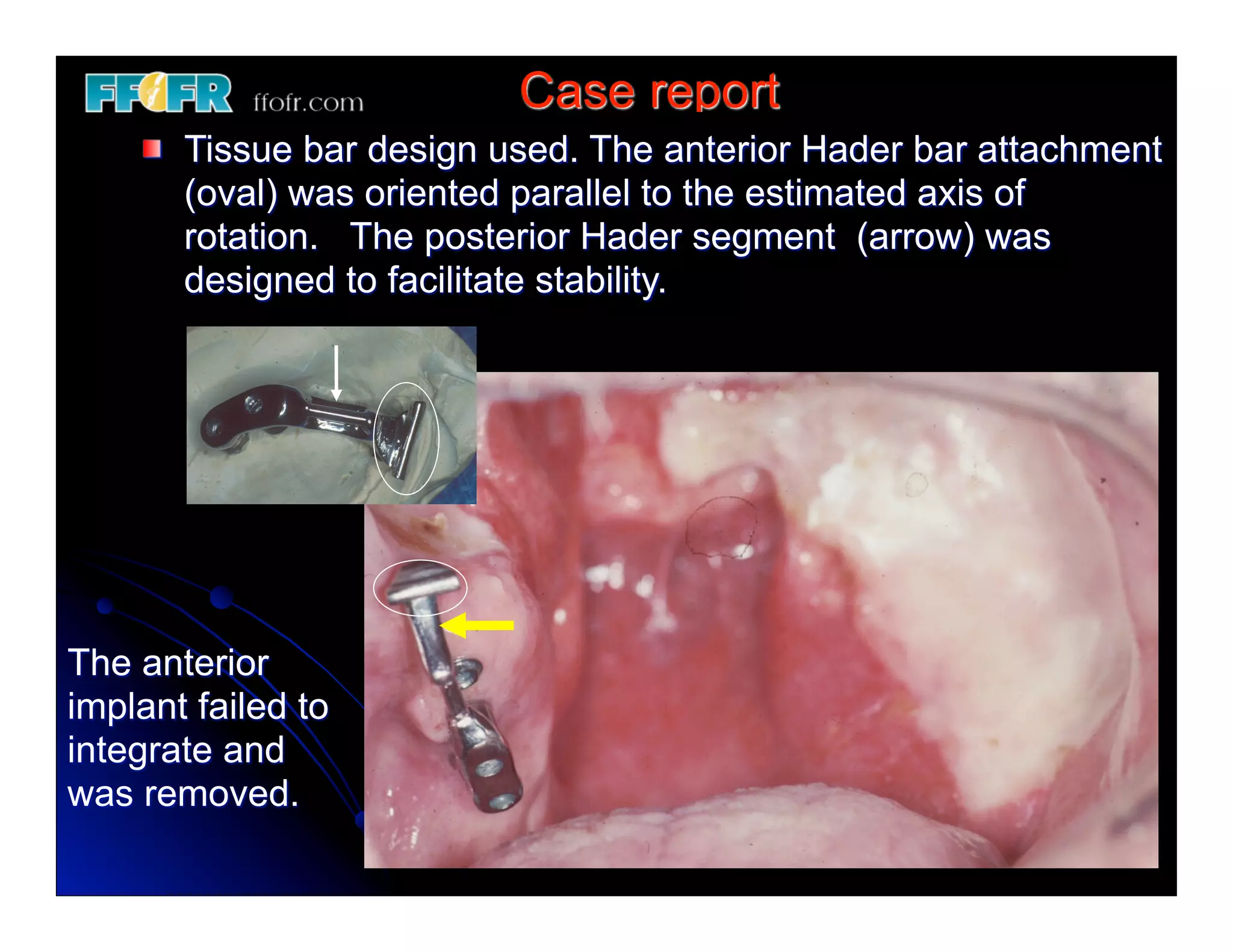 15. (new)implants maxillary defects | PDF