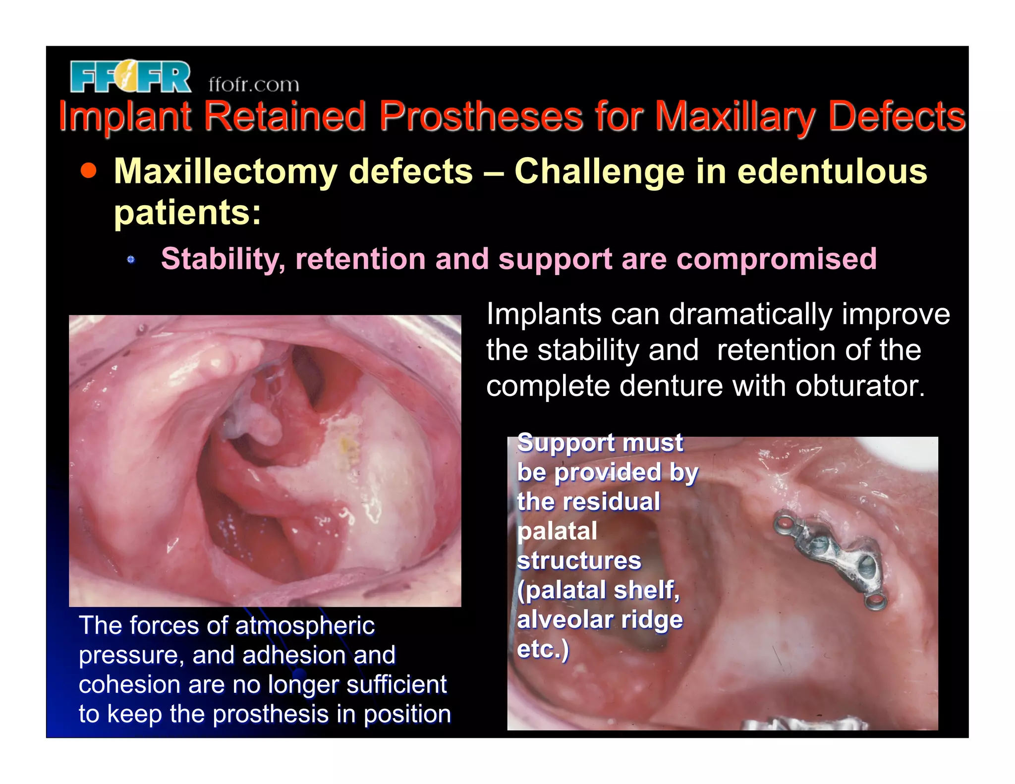 15. (new)implants maxillary defects | PDF