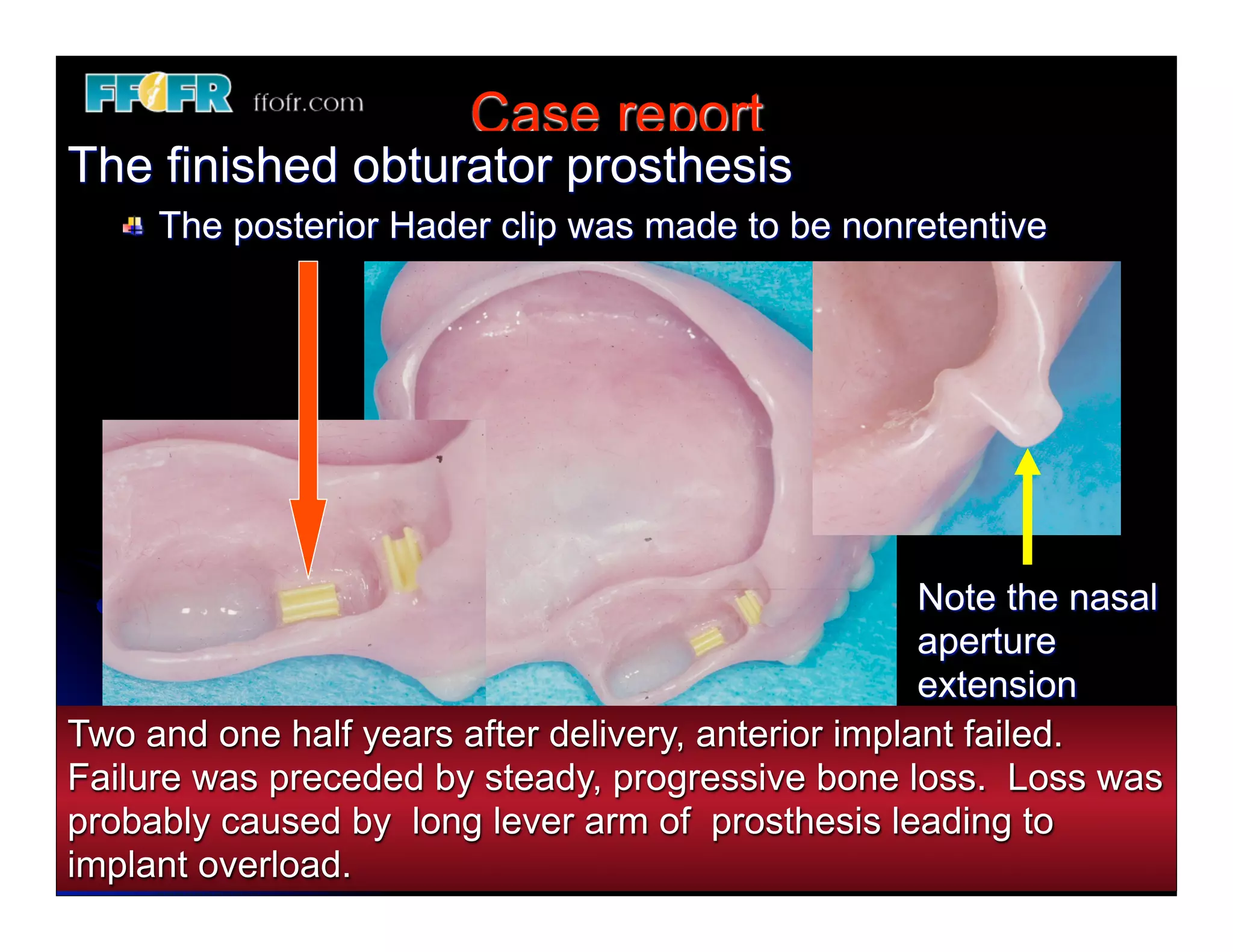 15. (new)implants maxillary defects | PDF