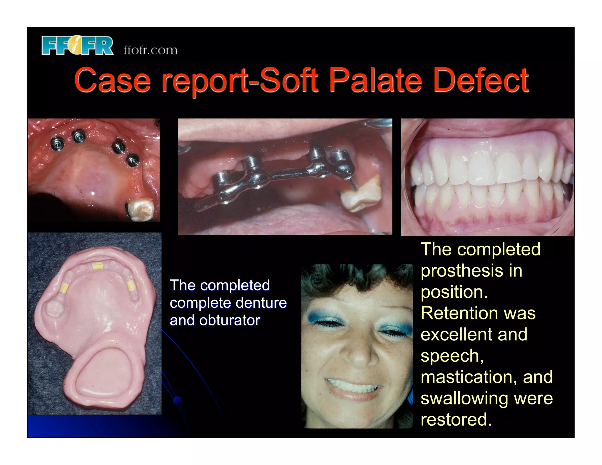 15. (new)implants maxillary defects | PDF