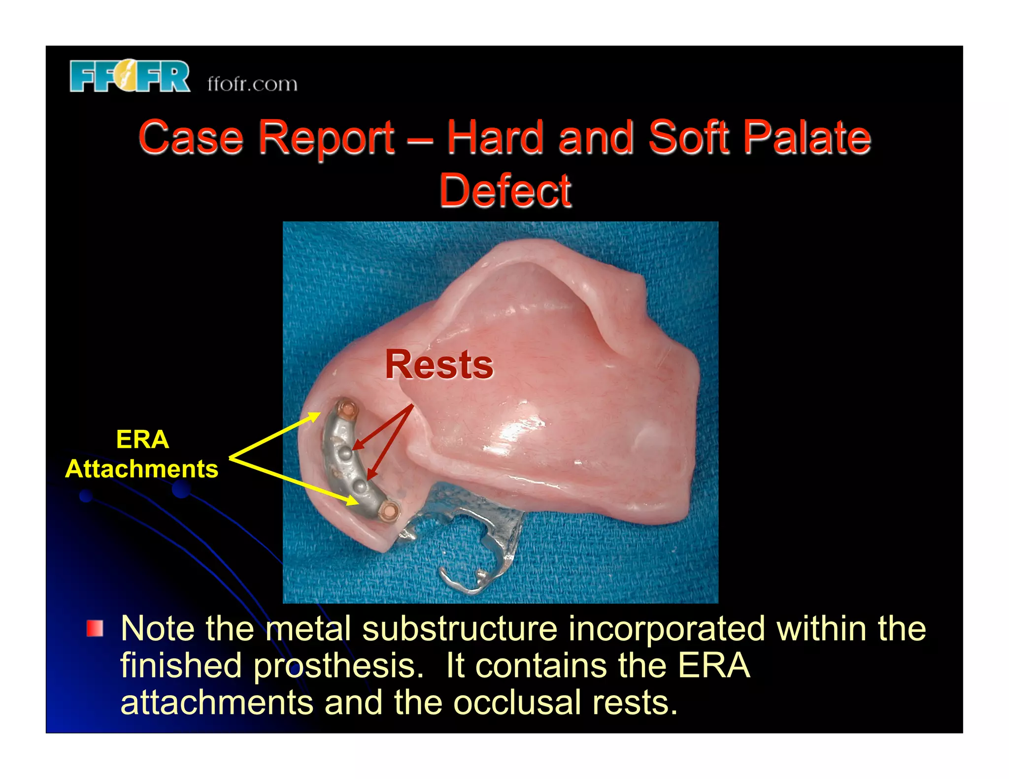 15. (new)implants maxillary defects | PDF