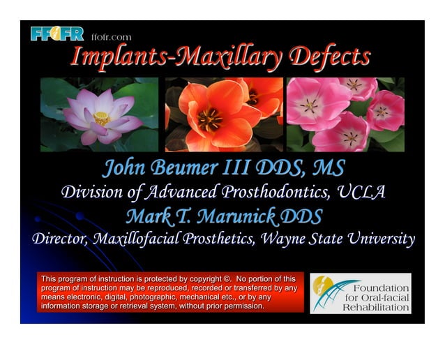 15. (new)implants maxillary defects | PPT