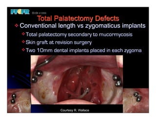 15. (new)implants maxillary defects | PDF