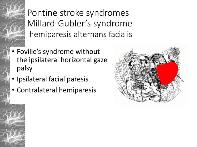 15-Posterior-Circulation-Stroke - Neurologypdf | PPT
