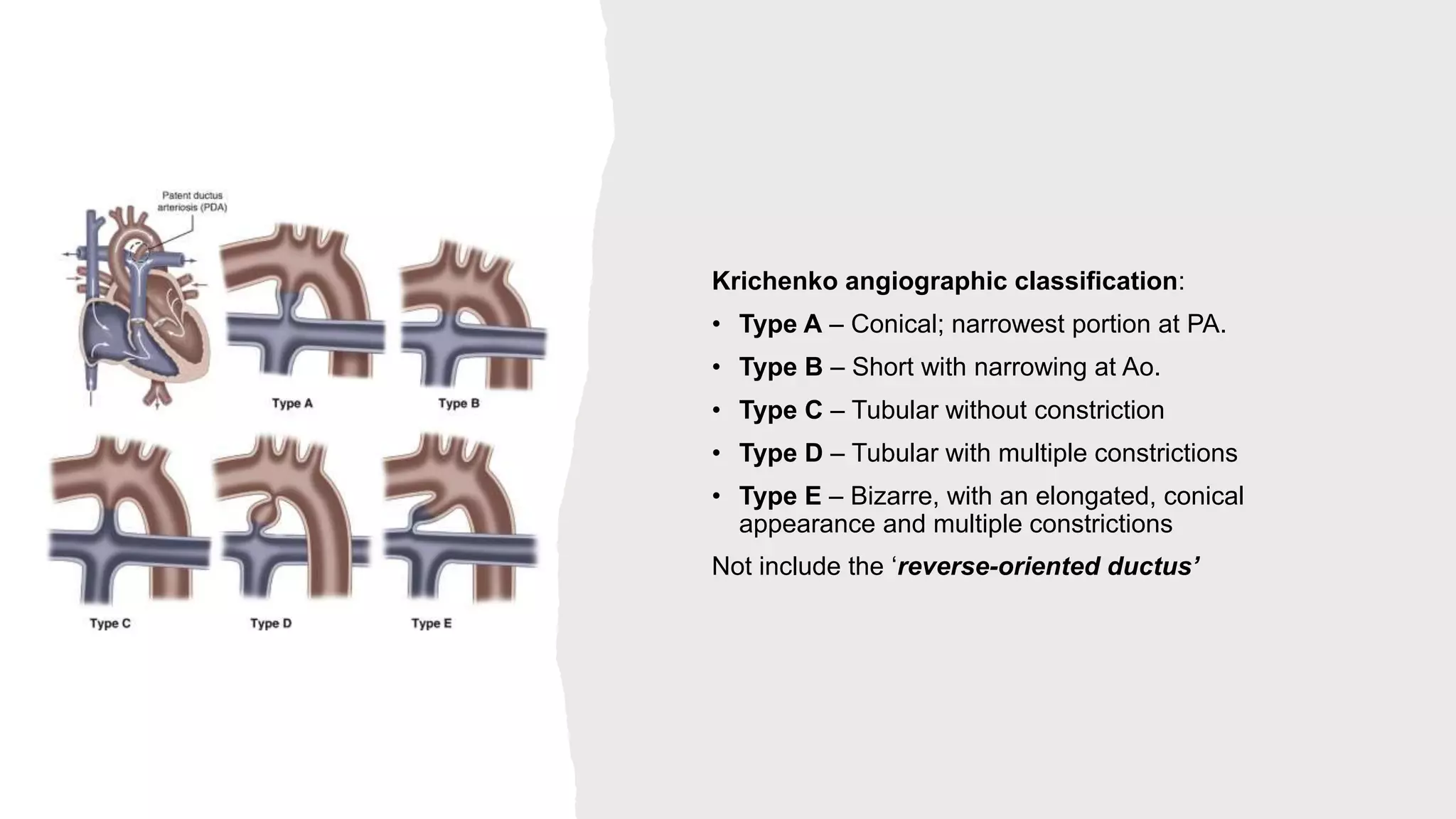 Patent Ductus Arteriosus (PDA) Echocardiographic Assessment: Anatomy ...