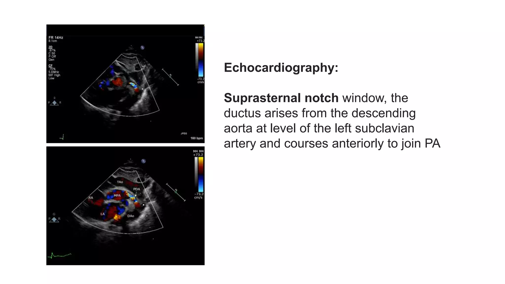 Patent Ductus Arteriosus (PDA) Echocardiographic Assessment: Anatomy ...