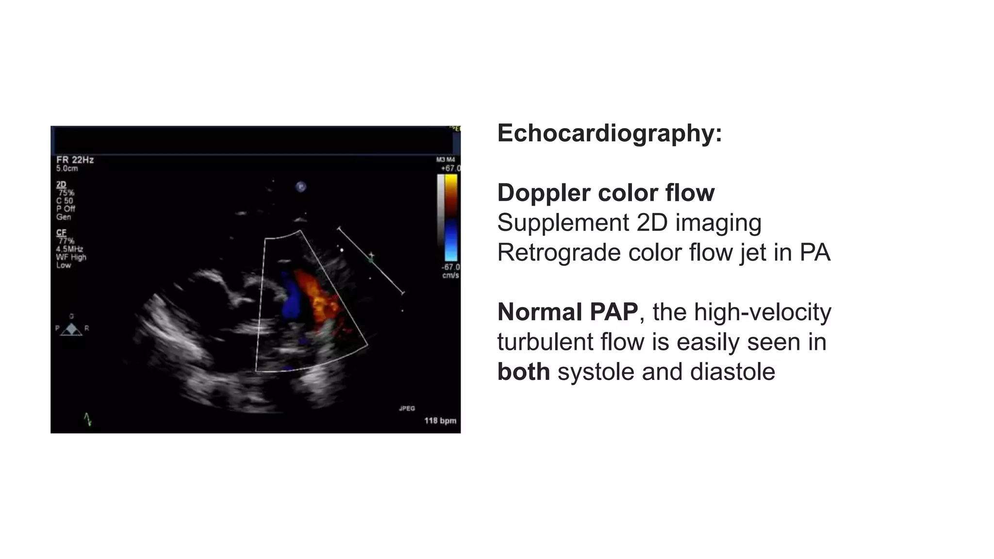 Patent Ductus Arteriosus (PDA) Echocardiographic Assessment: Anatomy ...