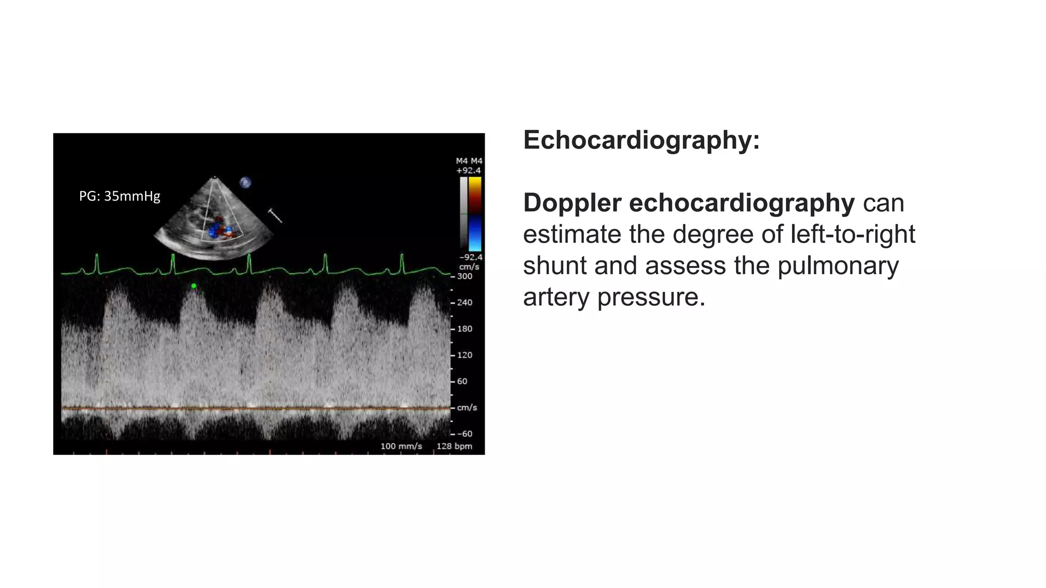 Patent Ductus Arteriosus (PDA) Echocardiographic Assessment: Anatomy ...