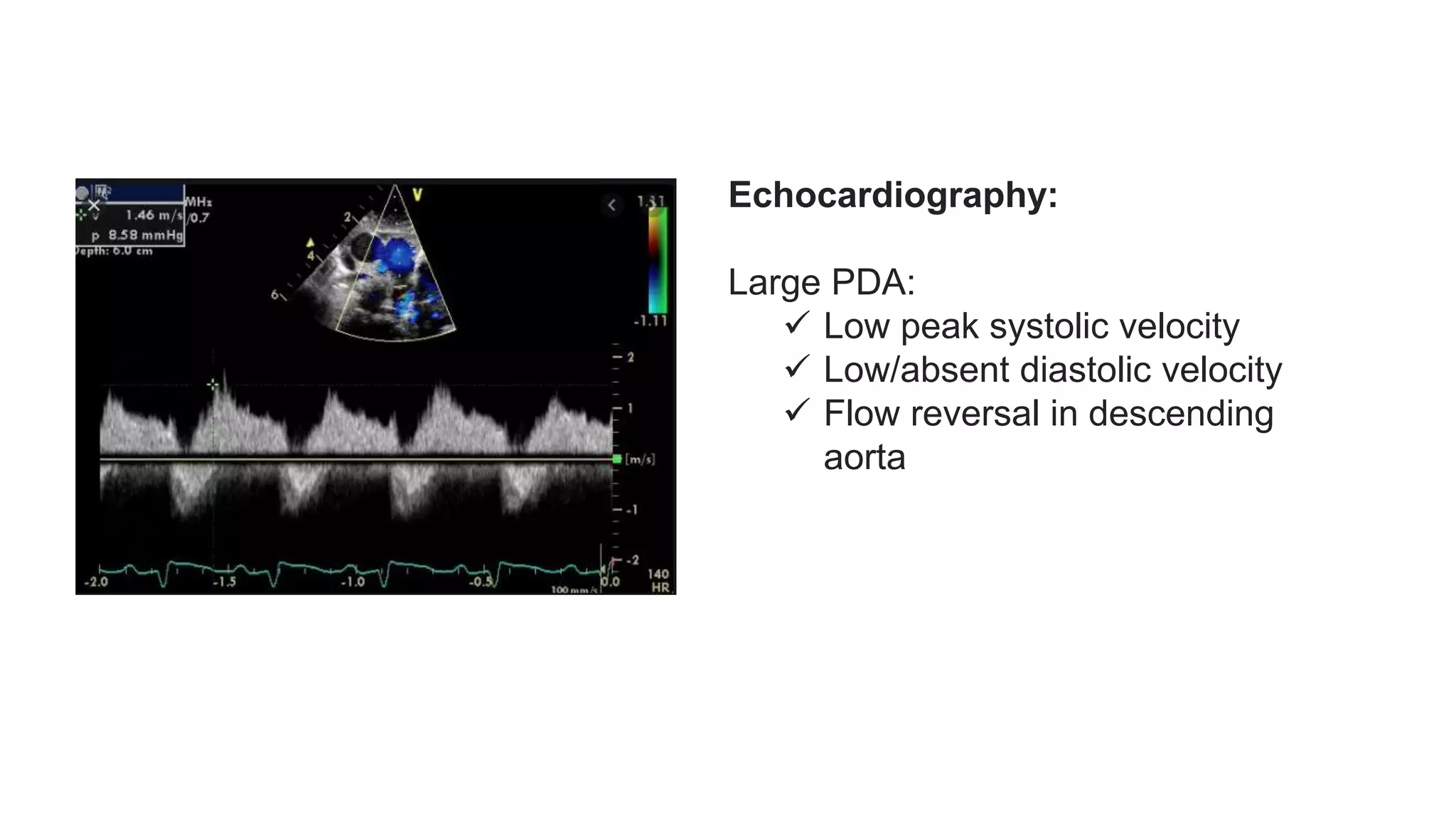 Patent Ductus Arteriosus (PDA) Echocardiographic Assessment: Anatomy ...