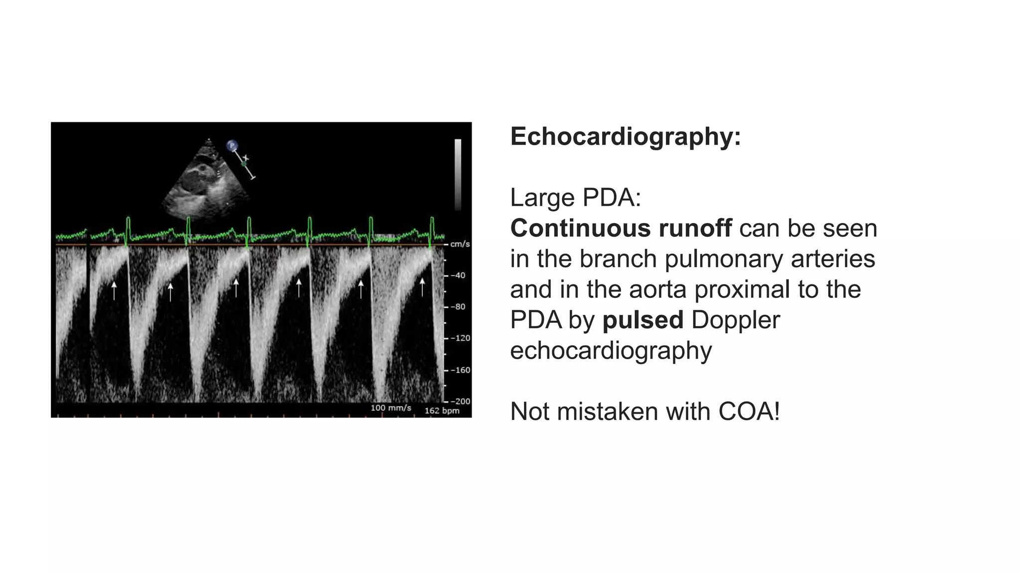 Patent Ductus Arteriosus (PDA) Echocardiographic Assessment: Anatomy ...