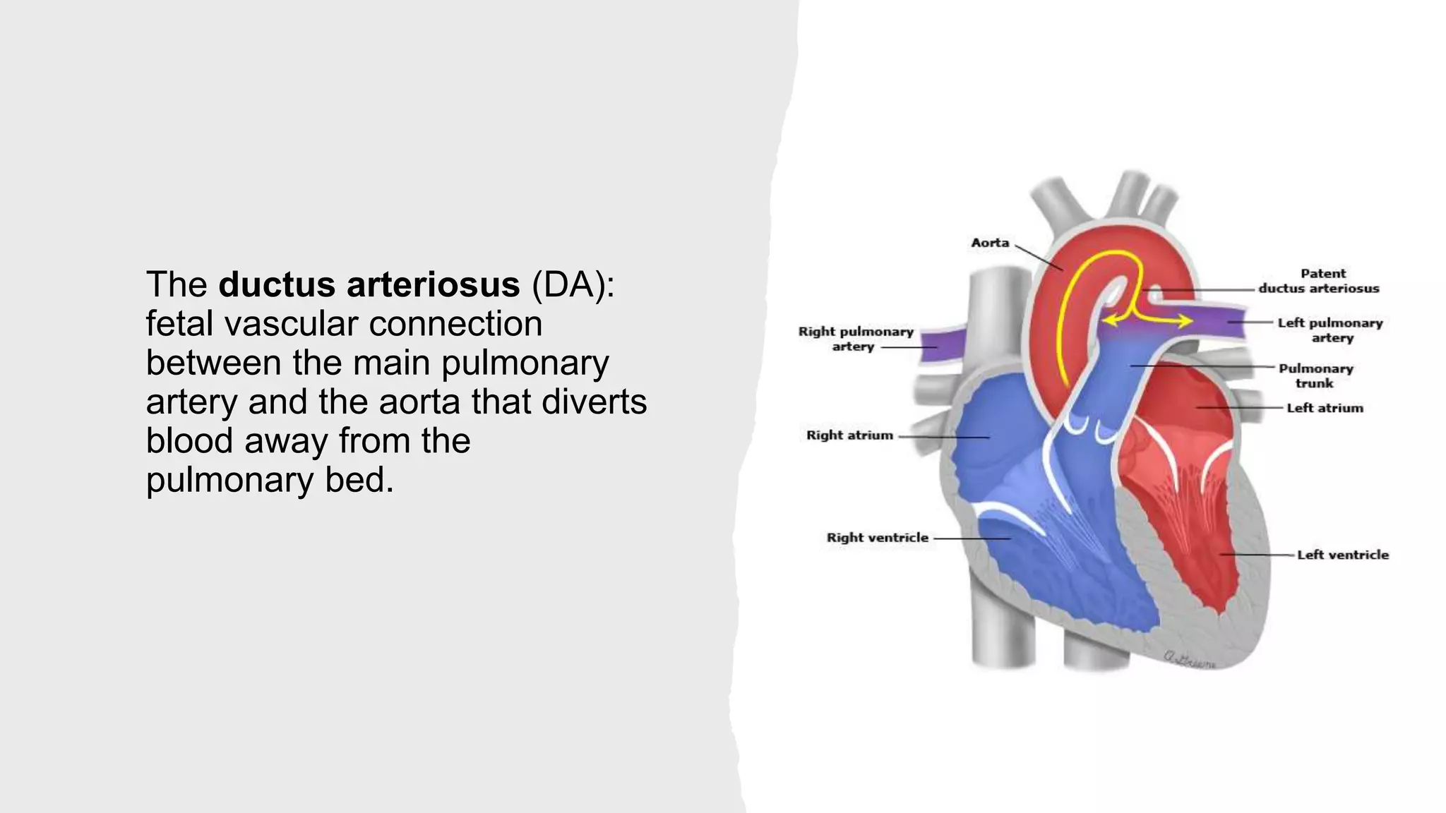 Patent Ductus Arteriosus (PDA) Echocardiographic Assessment: Anatomy ...