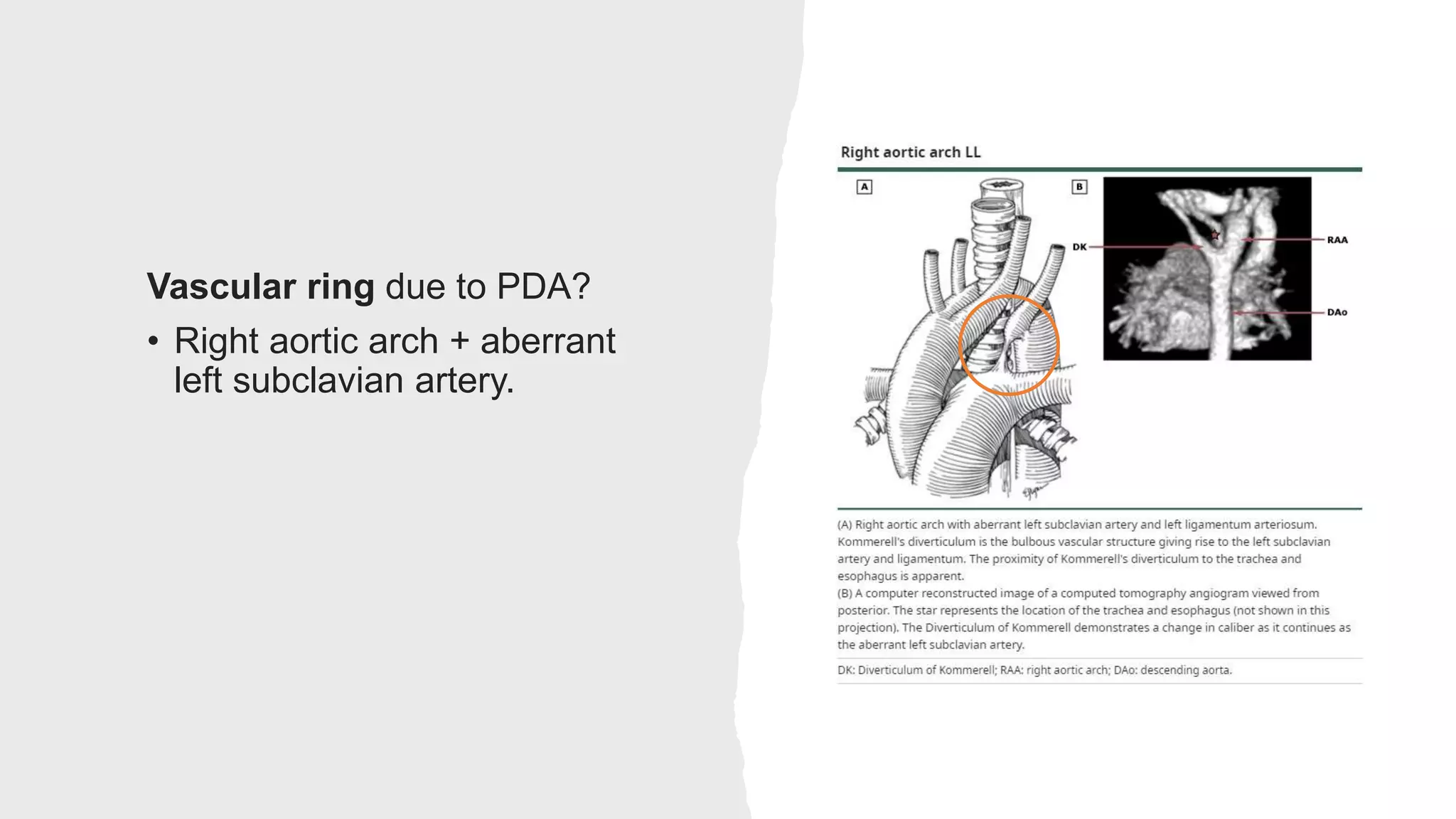 Patent Ductus Arteriosus (PDA) Echocardiographic Assessment: Anatomy ...