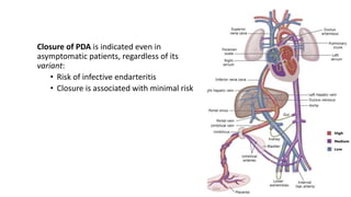 Patent Ductus Arteriosus (PDA) Echocardiographic Assessment: Anatomy ...