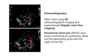 Patent Ductus Arteriosus (PDA) Echocardiographic Assessment: Anatomy ...