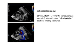 Patent Ductus Arteriosus (PDA) Echocardiographic Assessment: Anatomy ...