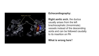 Patent Ductus Arteriosus (PDA) Echocardiographic Assessment: Anatomy ...