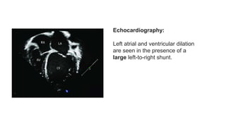 Patent Ductus Arteriosus (PDA) Echocardiographic Assessment: Anatomy ...