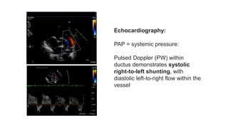 Patent Ductus Arteriosus (PDA) Echocardiographic Assessment: Anatomy ...