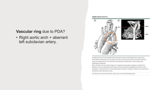 Patent Ductus Arteriosus (PDA) Echocardiographic Assessment: Anatomy ...